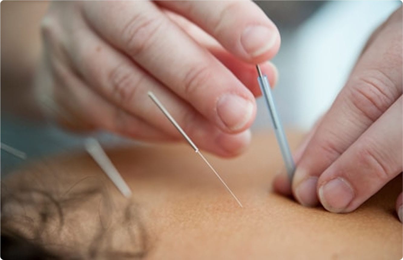 Dry Needling & Acupuncture North Sydney | Acu Physiotherapy